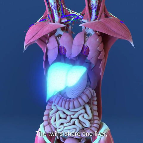 Two Heads, One Body: Anatomy of Conjoined Twins » WIMKIN - Free Speech ...